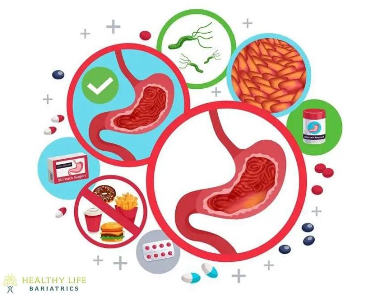 How to Avoid Dumping Syndrome in Los Angeles, CA | HLB