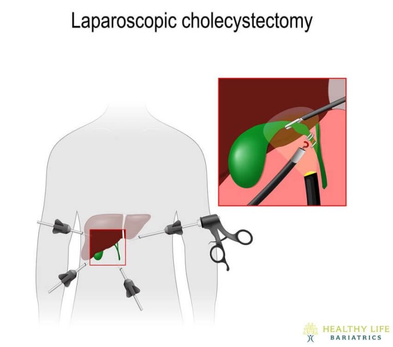 Is Gallbladder Removal Surgery Safe? Los Angeles, CA | HLB